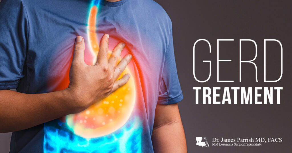 GERD Surgery for Acid Reflux Alexandria Natchez LA